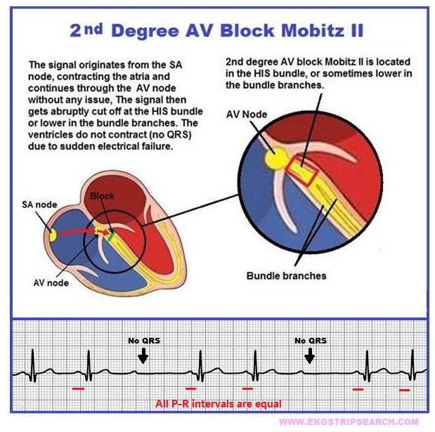 2nd Degree Mobitz 2 Heart Block Is A Defect Or Disease Of The HIS 